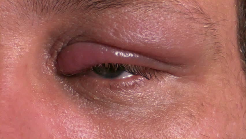 Man With Infected Eye Uncomfortable, 4K Stock Footage Video 14192003 ...