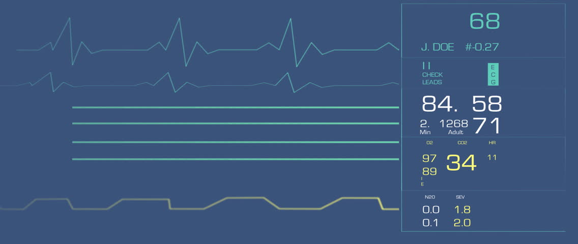 Patient's Revival, ICU Monitor With Vital Signs Rising After Cardiac ...