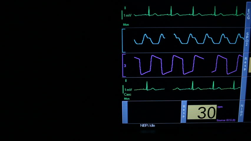 Animation Of Schematic Intensive Care Unit Monitor Showing Normal ...