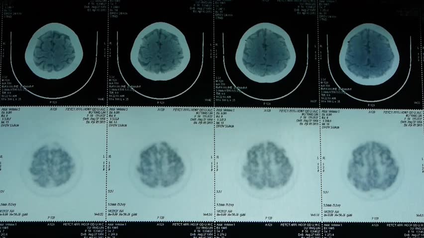Moving Head Pet CT Scan,skull Brain X-ray. Gh2_06250 Stock Footage ...