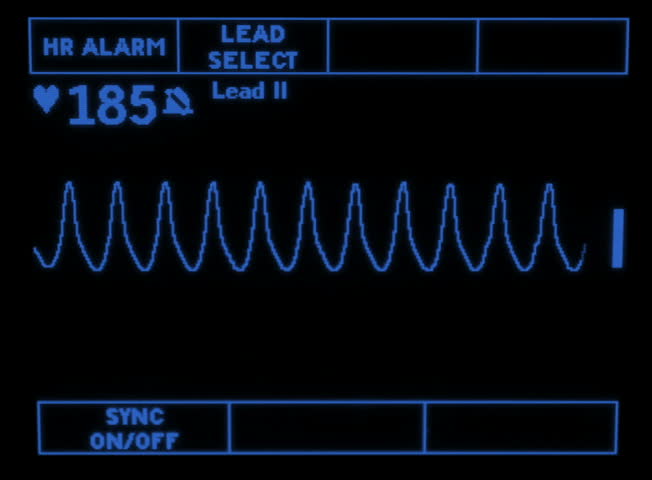 A Simulated Monitor Showing The Sinus Tachycardia Rhythm. 库存影片视频 ...